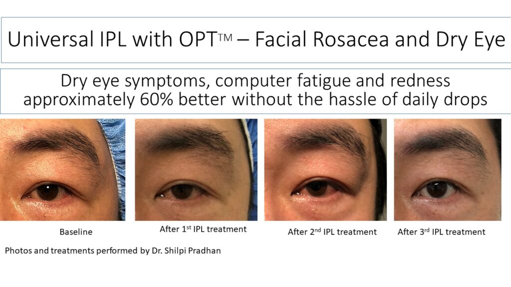 Intense Pulsed Light (IPL) - Eye Doctor MD PC